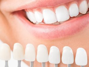 Composite Veneers in Ahwatukee, Phoenix | Atrium Dental