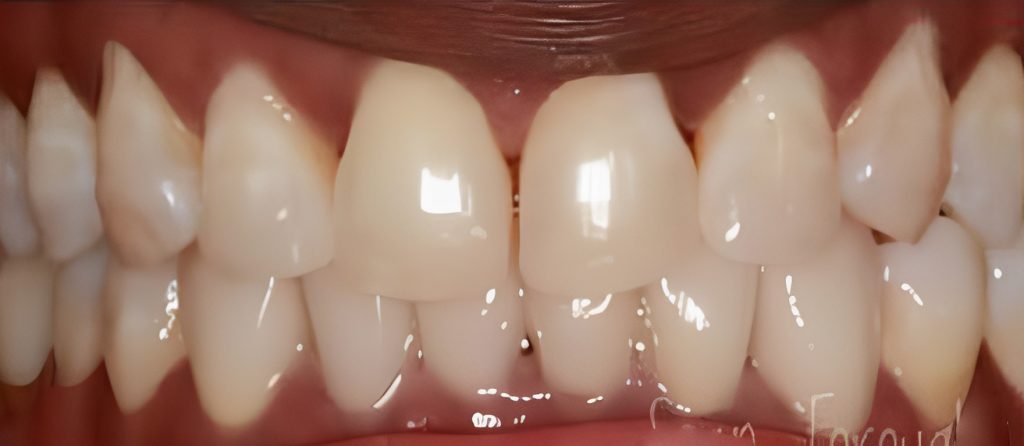 Dental Bridge in Ahwatukee, Phoenix, AZ