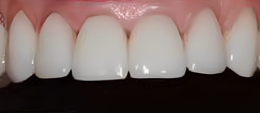 Composite Filling vs Veneer Before and After - Atrium Dental