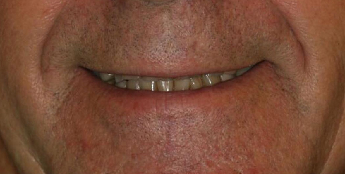 Best Snap-On Veneers for Missing Teeth in Phoenix, AZ