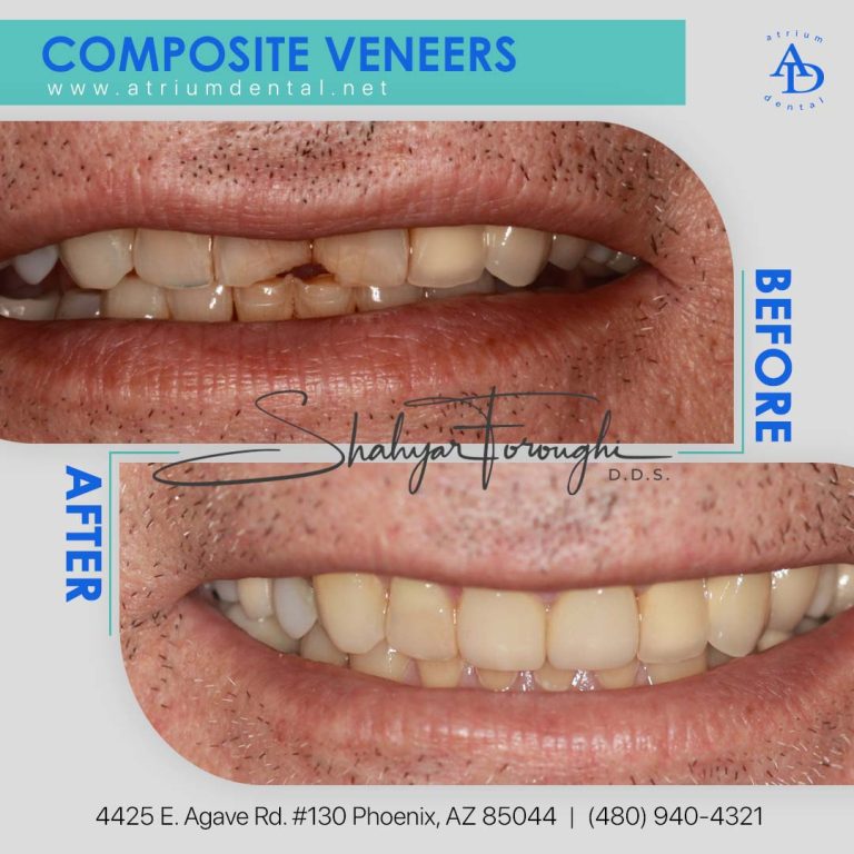 Composite Veneers in Ahwatukee, Phoenix | Atrium Dental