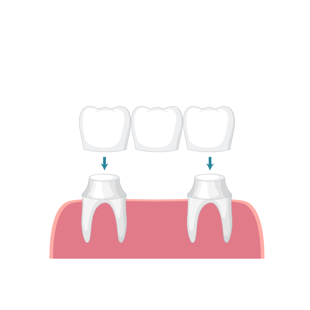Tooth Extraction and Temporary Bridge; Pros and Cons | Atrium Dental