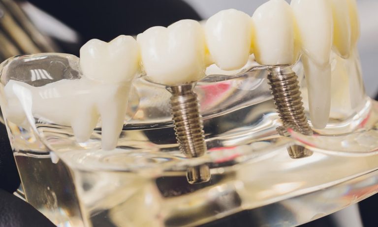 One-Stage vs. Two-Stage Dental Implant, What are the Differences?