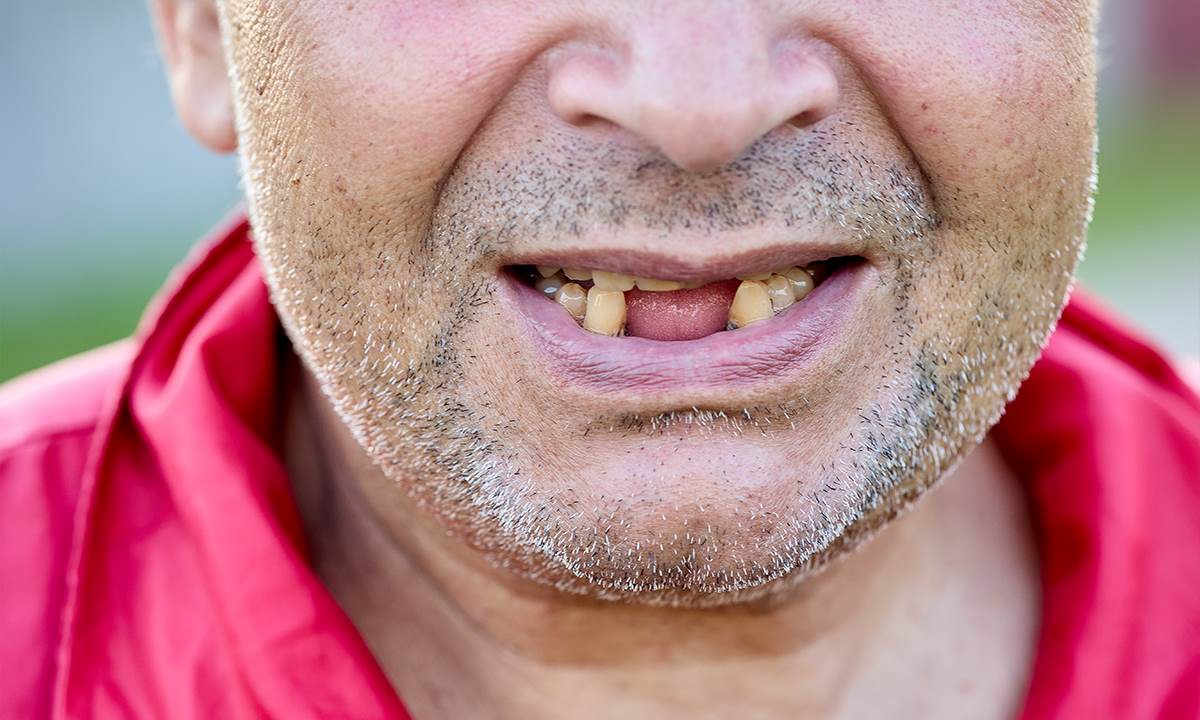 Tooth Loss in Adults: Causes & Prevention & Solutions | Atrium Dental