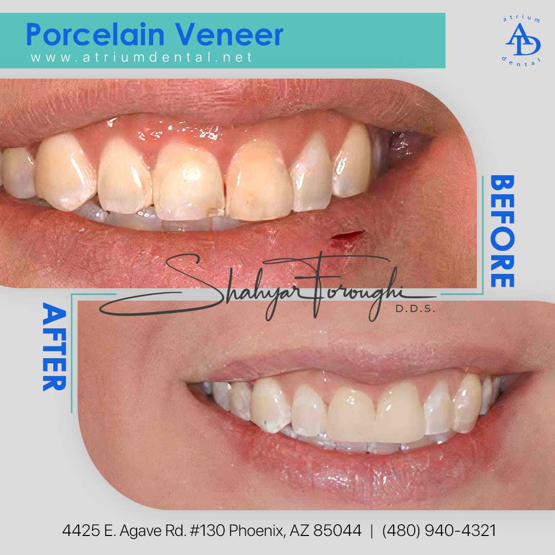 Porcelain Veneers Tempe, Arizona | Atrium Dental