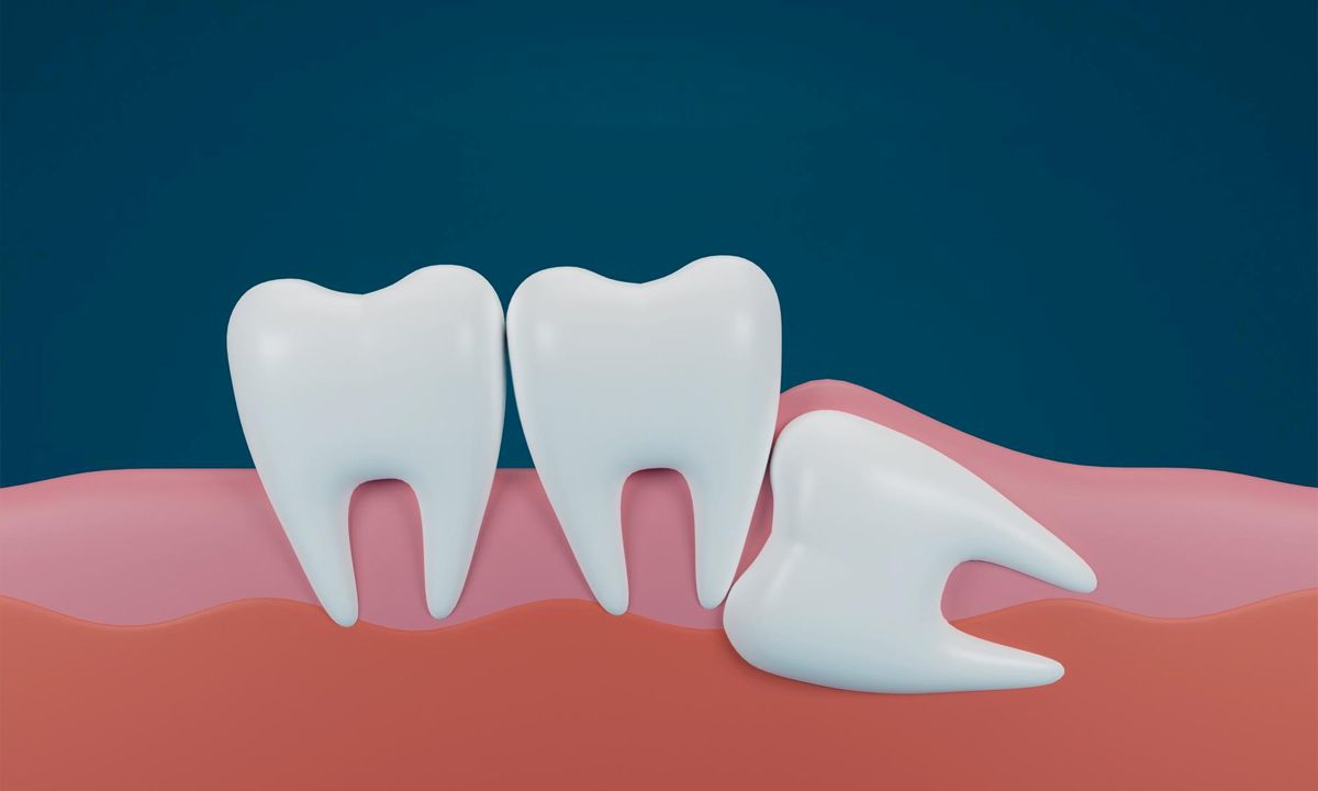 Can Wisdom Teeth Grow Back? | Atrium Dental